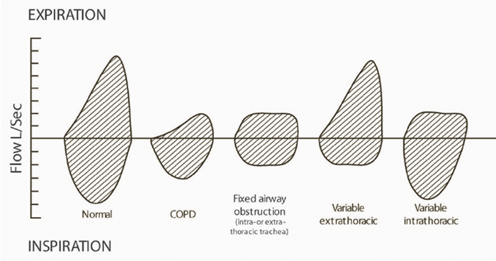 Laryngotracheal stenosis | ENT & Audiology News