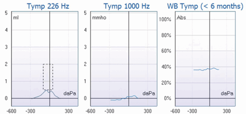 Multifrequency tympanometry | ENT & Audiology News
