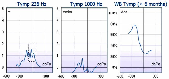 Multifrequency tympanometry | ENT & Audiology News