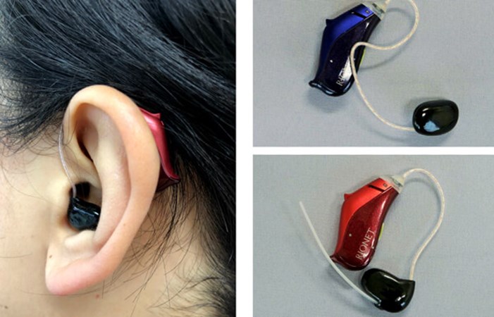 Cartilage conduction hearing aids: the third pathway for sound ...