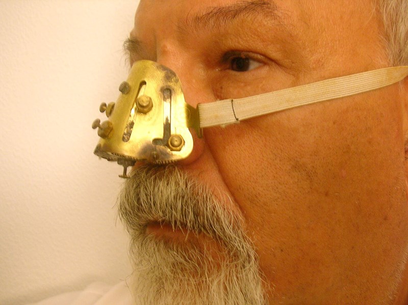 The golden nose – reshaping the nose 100 years ago | ENT & Audiology News