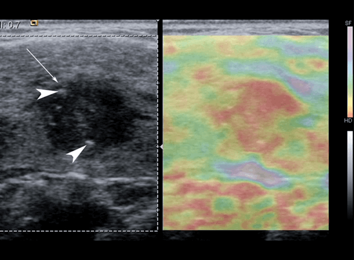 Thyroid ultrasound elastography: does nodule stiffness predict ...