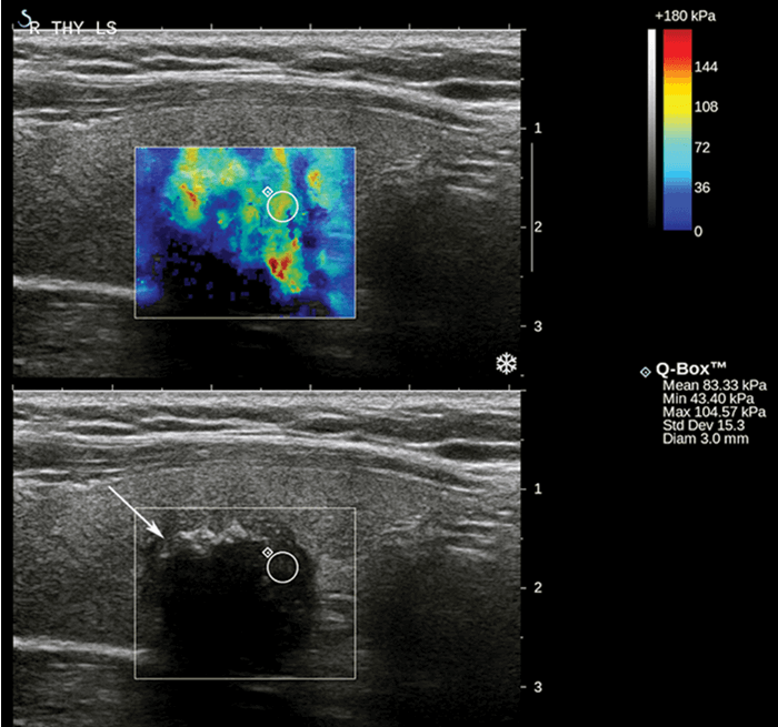 Thyroid ultrasound elastography: does nodule stiffness predict ...