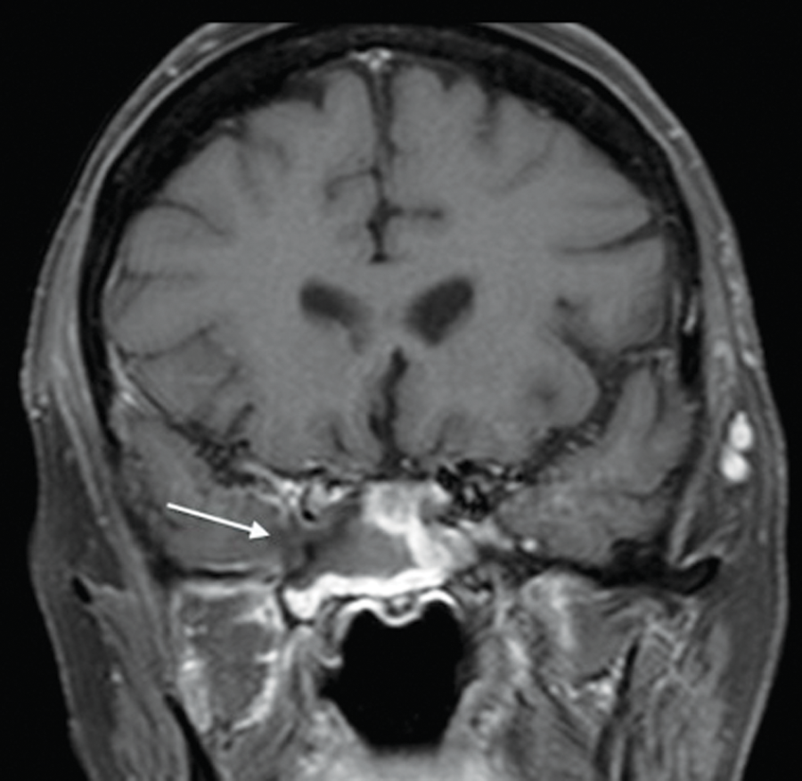Sphenoid Sinus Mri