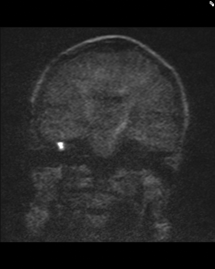 Detecting postoperative cholesteatoma with diffusion weighted magnetic ...