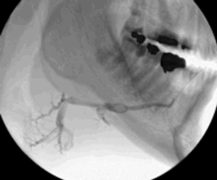Minimally invasive techniques for benign salivary gland obstruction ...