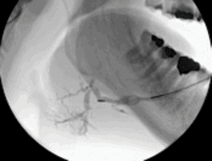Minimally invasive techniques for benign salivary gland obstruction ...