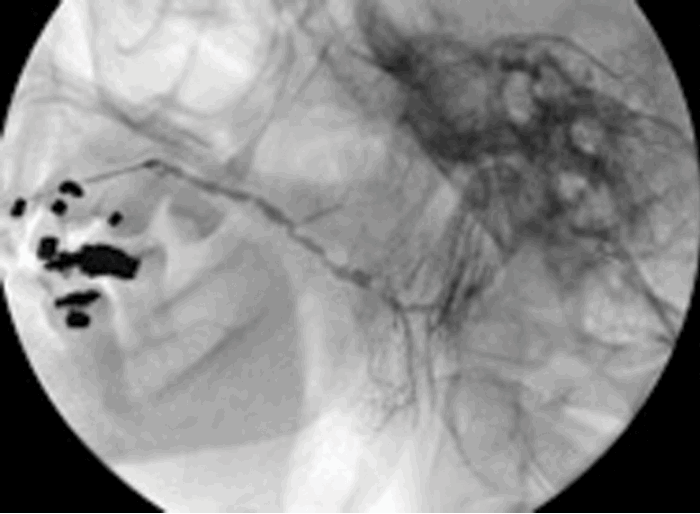 Minimally invasive techniques for benign salivary gland obstruction ...