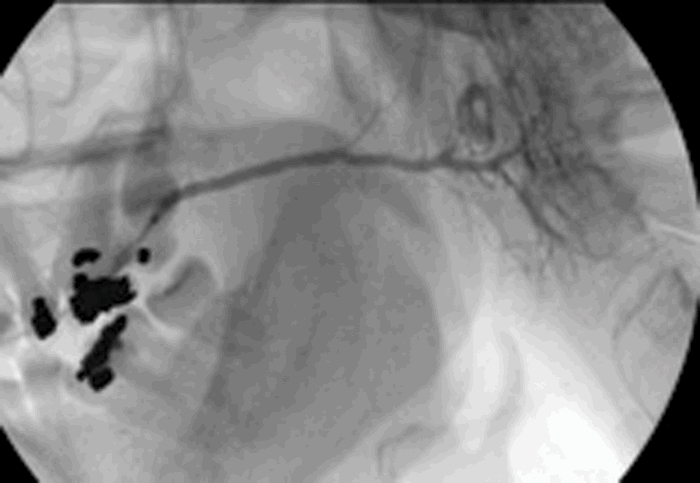 Minimally invasive techniques for benign salivary gland obstruction ...