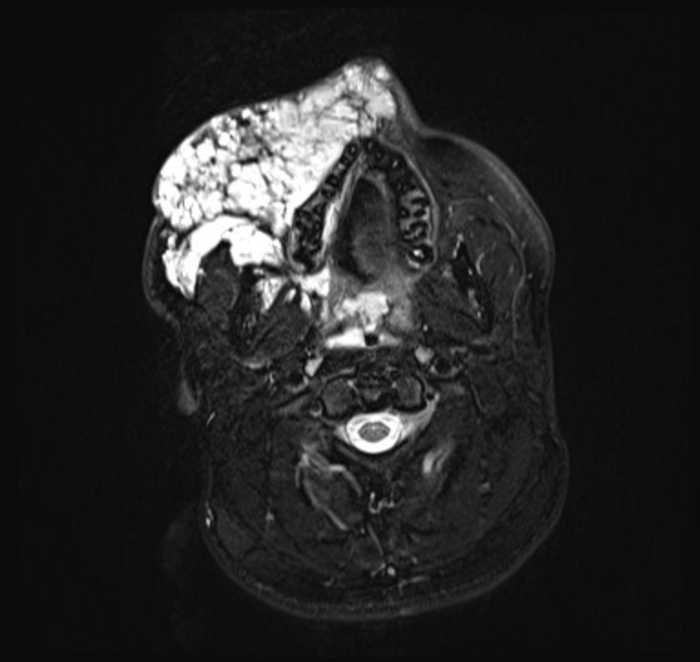 Imaging and management of head and neck vascular anomalies | ENT ...