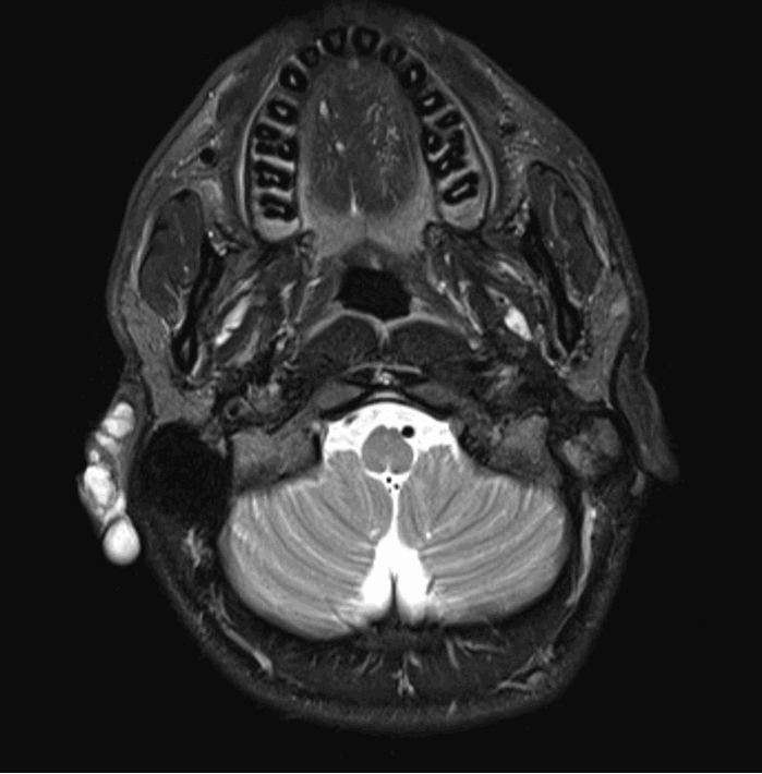 Imaging and management of head and neck vascular anomalies | ENT ...