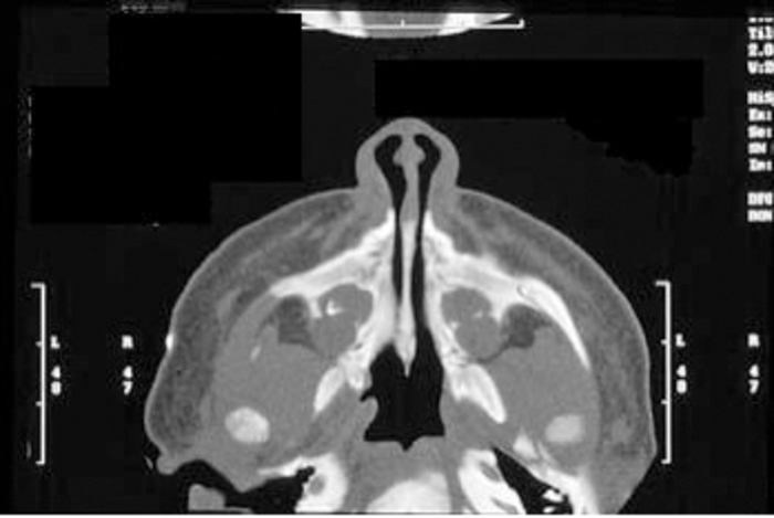 Surgical management of congenital nasal pyriform aperture stenosis ...
