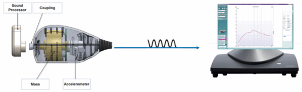 How to tell if a bone anchored hearing device is working? | ENT ...