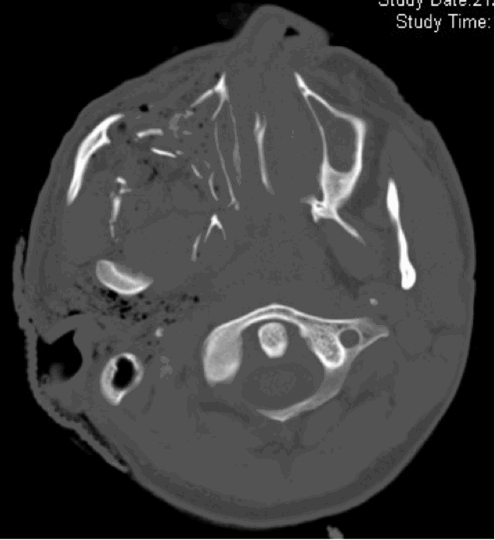 Temporal bone trauma | ENT & Audiology News