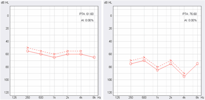 Effects of blast and acoustic trauma: assessment of hearing status on ...