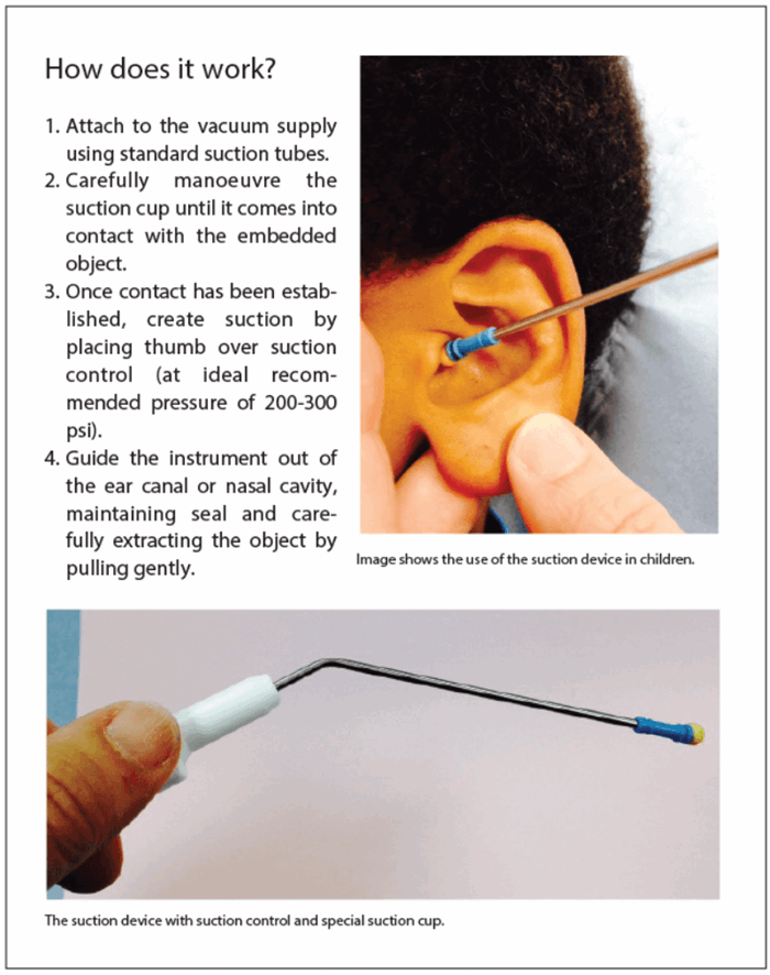 Foreign object removal from the ear or nose | ENT & Audiology News