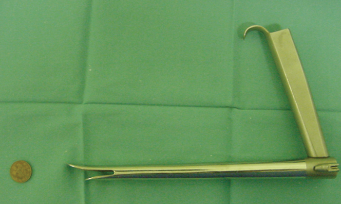 CO2 Laser Dohlmans: Does It Still Have A Role In Pharyngeal Pouch ...