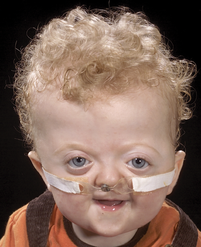 Sleep apnoea in children with craniofacial syndromes | ENT & Audiology News