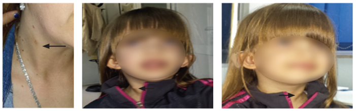 Branchio Oto Renal syndrome | ENT & Audiology News