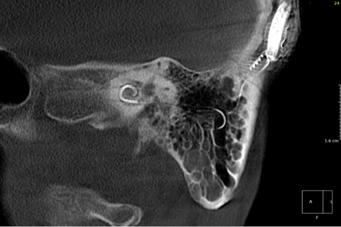 How to safely image patients with cochlear implants | ENT & Audiology News