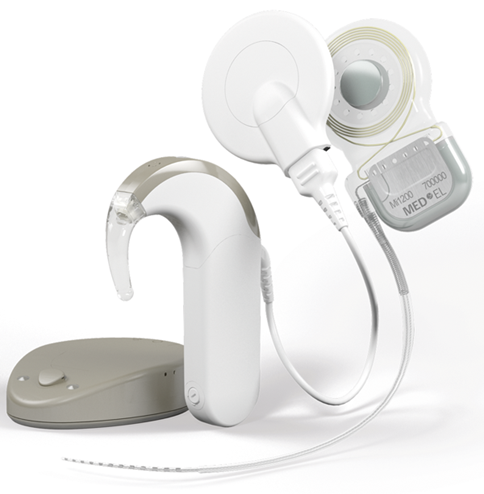 Rehabilitation of single-sided deafness with cochlear implants | ENT ...