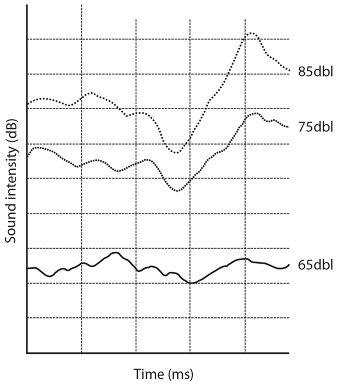 Superior semicircular canal dehiscence syndrome | ENT & Audiology News
