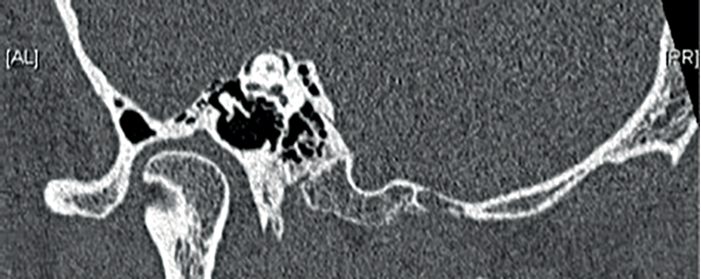 Superior semicircular canal dehiscence syndrome | ENT & Audiology News