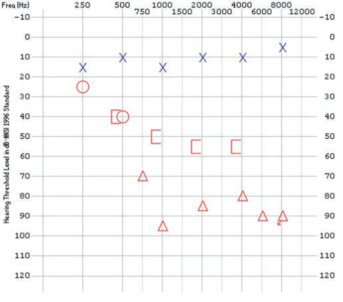 Cytomegalovirus (CMV) and the vestibular system: a case study | ENT ...