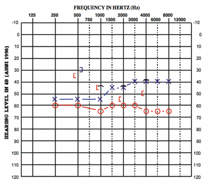 Audiovestibular findings in children with enlarged vestibular aqueduct ...