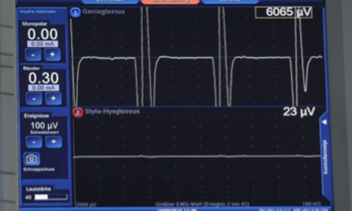Selective upper airway stimulation | ENT & Audiology News