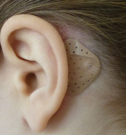 Adjoin™ bone conduction system | ENT & Audiology News