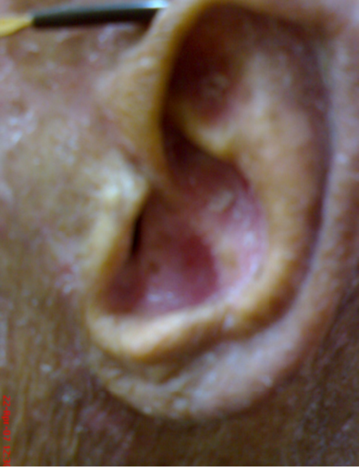 Audiological approach to treatment of blast-induced tinnitus | ENT ...