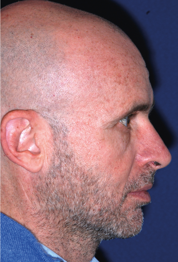 Rhinoplasty: state-of-the-art | ENT & Audiology News