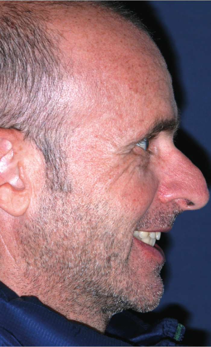 Rhinoplasty: state-of-the-art | ENT & Audiology News