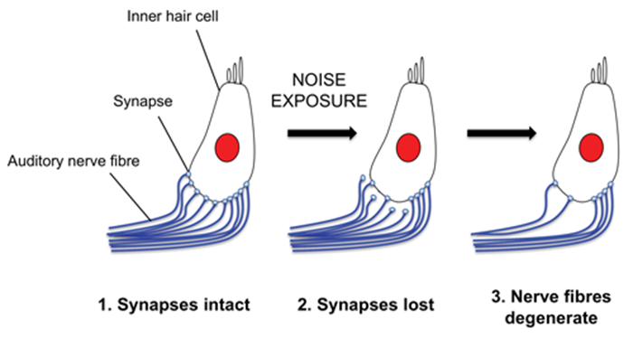 Hidden hearing loss in humans | ENT & Audiology News